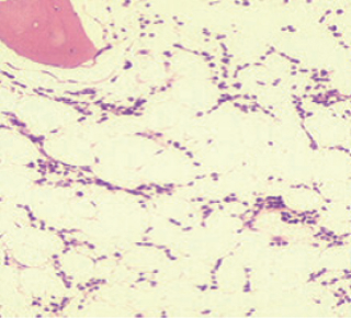 Aplastic anemia · Disease information | Bone Marrow Failure Center ...