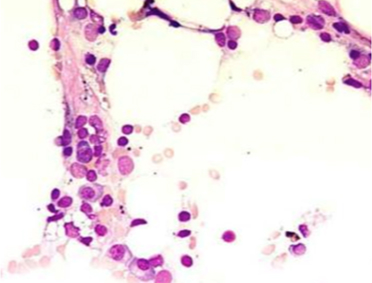 Paroxysmal nocturnal hemoglobinuria (PNH) · Disease information | Bone ...