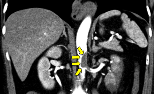 Paroxysmal nocturnal hemoglobinuria (PNH) · Disease information | Bone ...